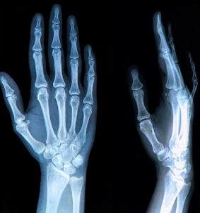 Chest X-Ray Urgent Care: Immediate Imaging Solutions